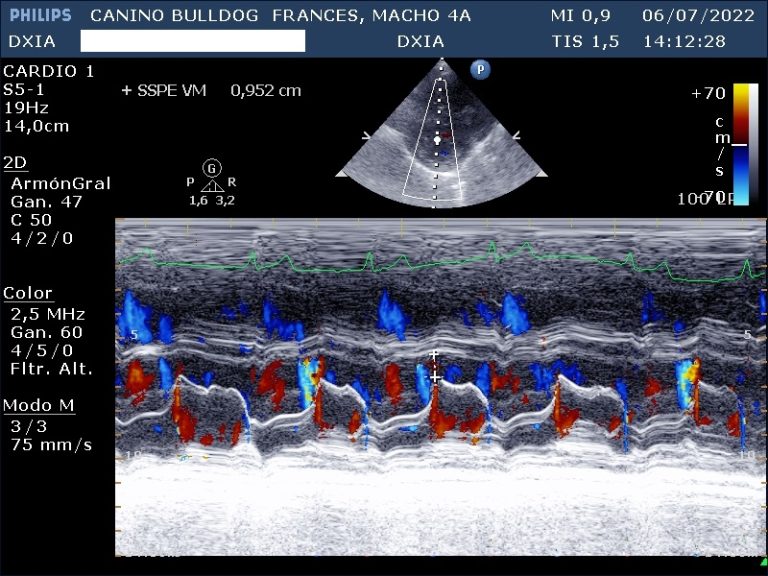 Estenosis pulmonar y displasia de la VT - DXIA
